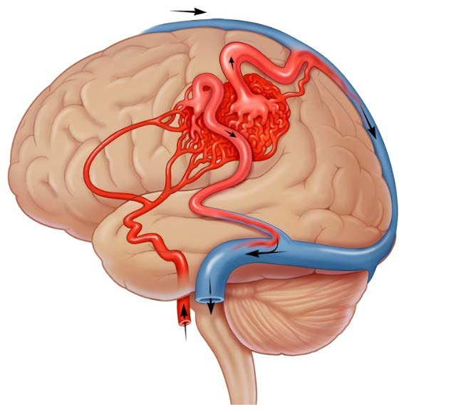 HKBSSP – CEREBRAL ANEURYSM - Overview and Treatments