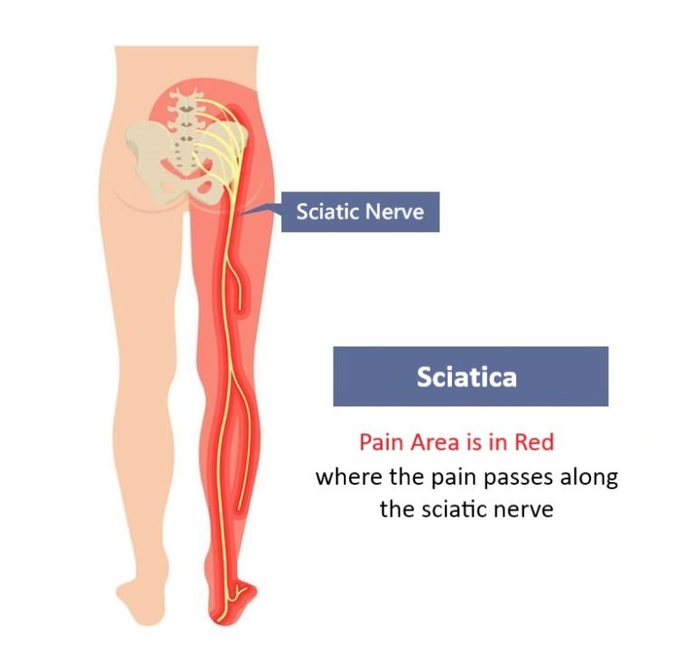 Spine Neurology Surgery What is the Sciatic Nerve? Who are the High-Risk Group of Developing ...