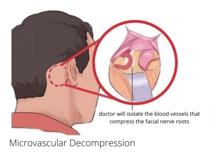 Hemifacial Spasm - Unusual Eye Twitching–