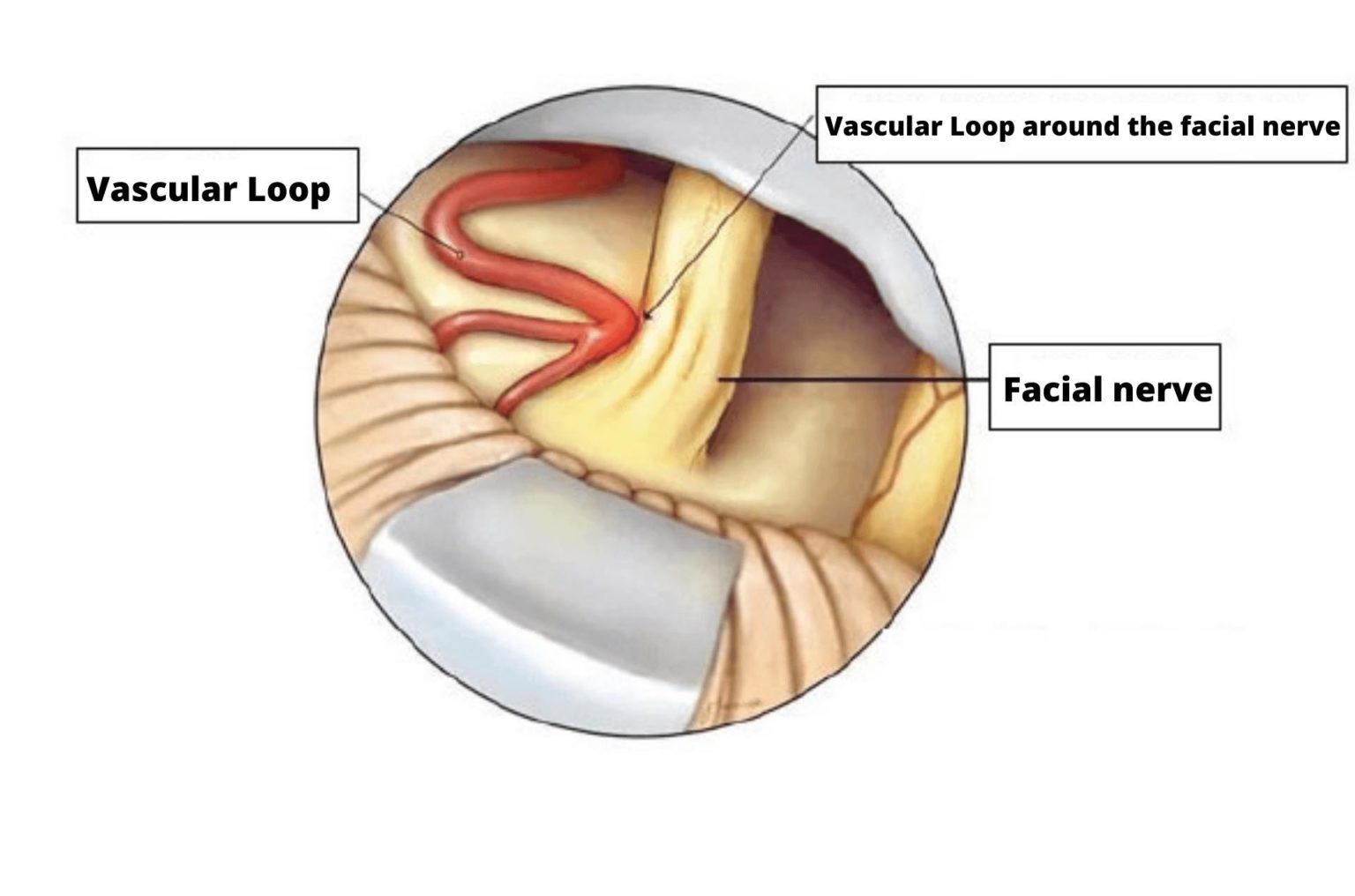 Hemifacial Spasm - Unusual Eye Twitching–