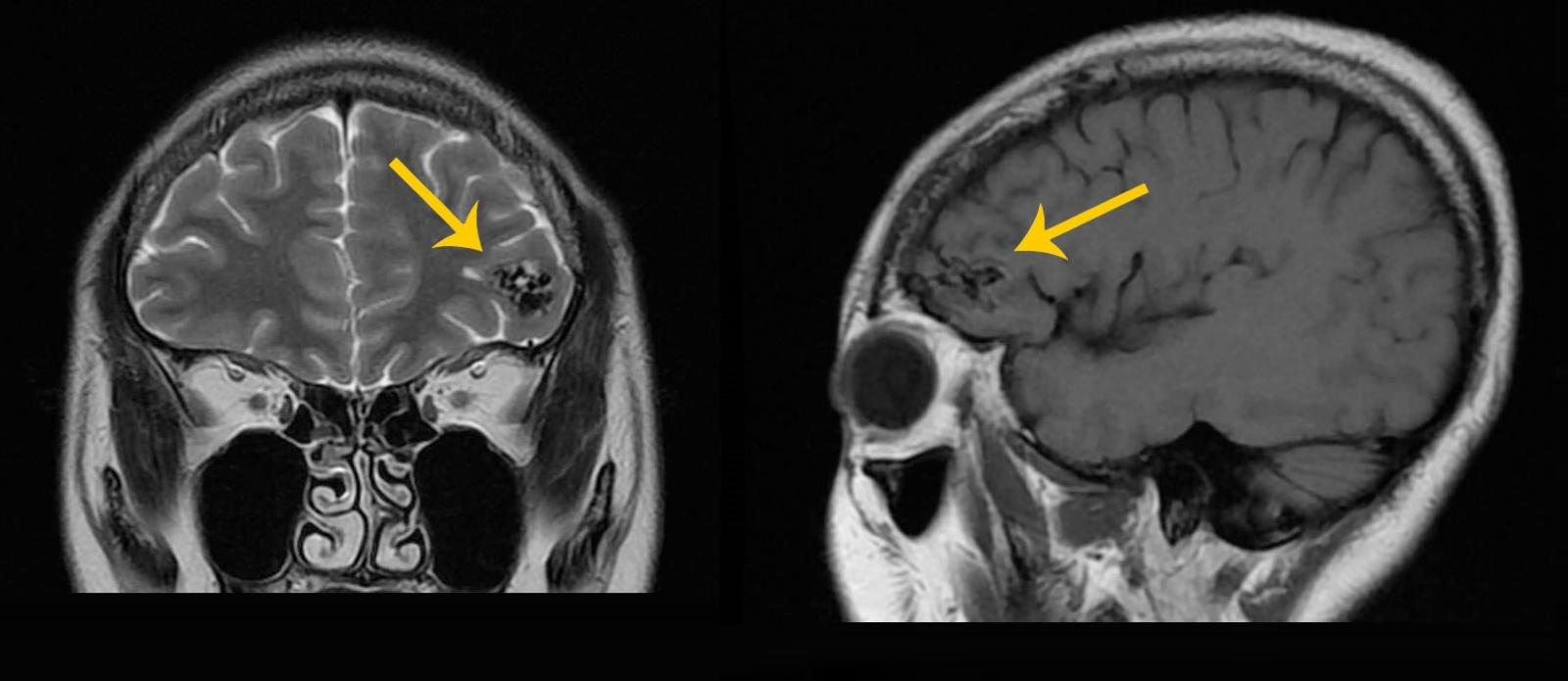 Treatment of Cerebral Arteriovenous Malformations (Part I ...